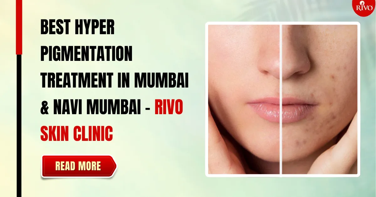 Best Hyper pigmentation Treatment: Say Goodbye to Dark Spots