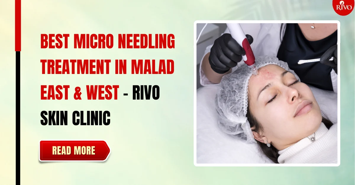 Best Micro Needling Treatment in Malad East & West - Rivo Clinic
