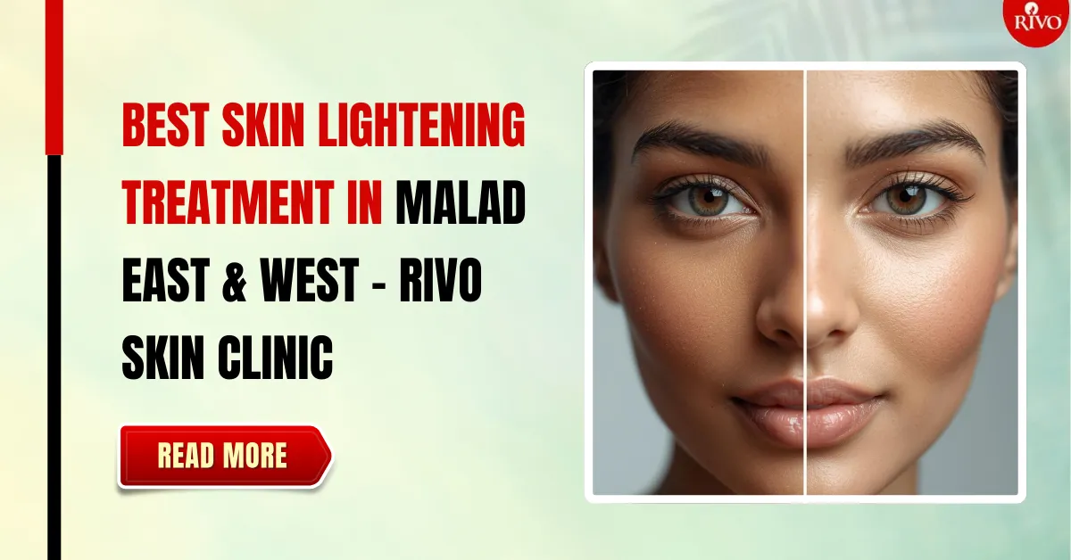 Best Skin Lightening Treatment in Malad East & West- Rivo Clinic